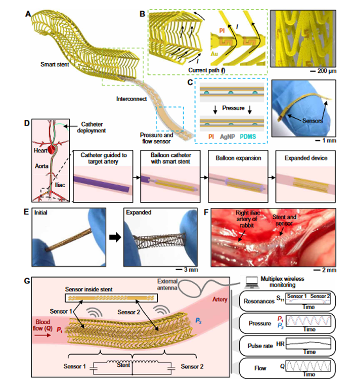 Printed Inductive Stent + Sensor Captures, Reports Blood-Flow Data ...